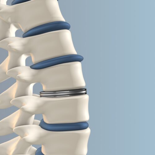 Types of Spinal Fusion Surgery | Patient Guide to Spine Procedures