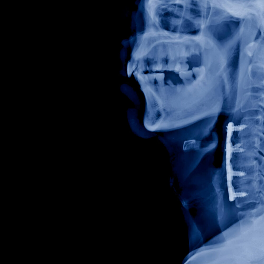 Naomi’s Story Before and After Selective Dorsal Rhizotomy