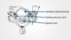 Spinal Cord Compression – Fact Versus Fiction