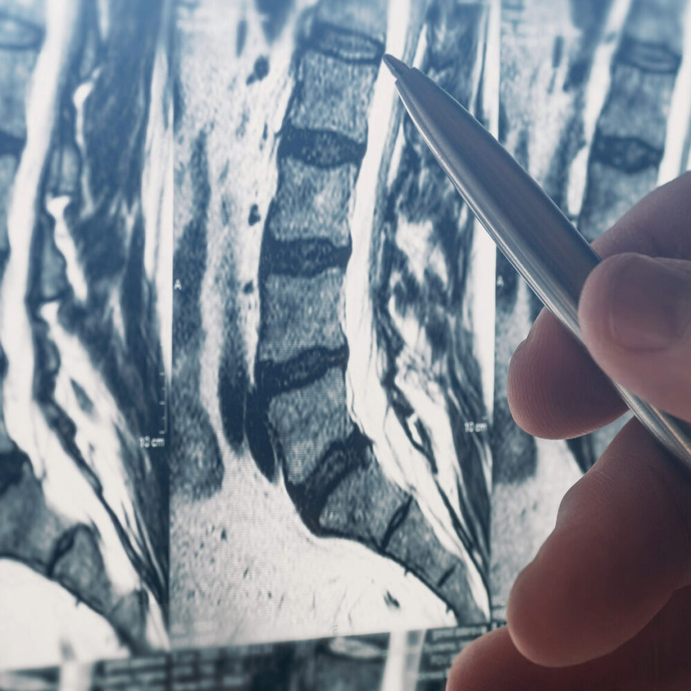 Spinal Stenosis FAQ: Causes, Symptoms and Treatment