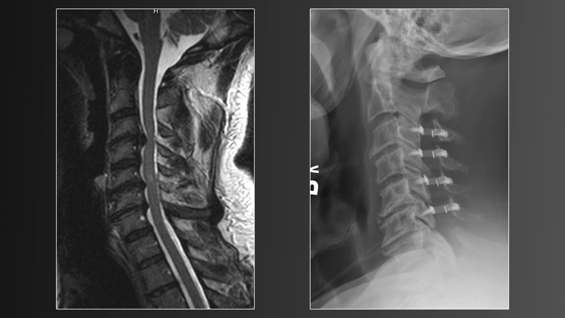 Cervical Laminoplasty A Simple Guide To Neck Surgery Cervical Laminoplasty A Simple Guide To Neck Surgery