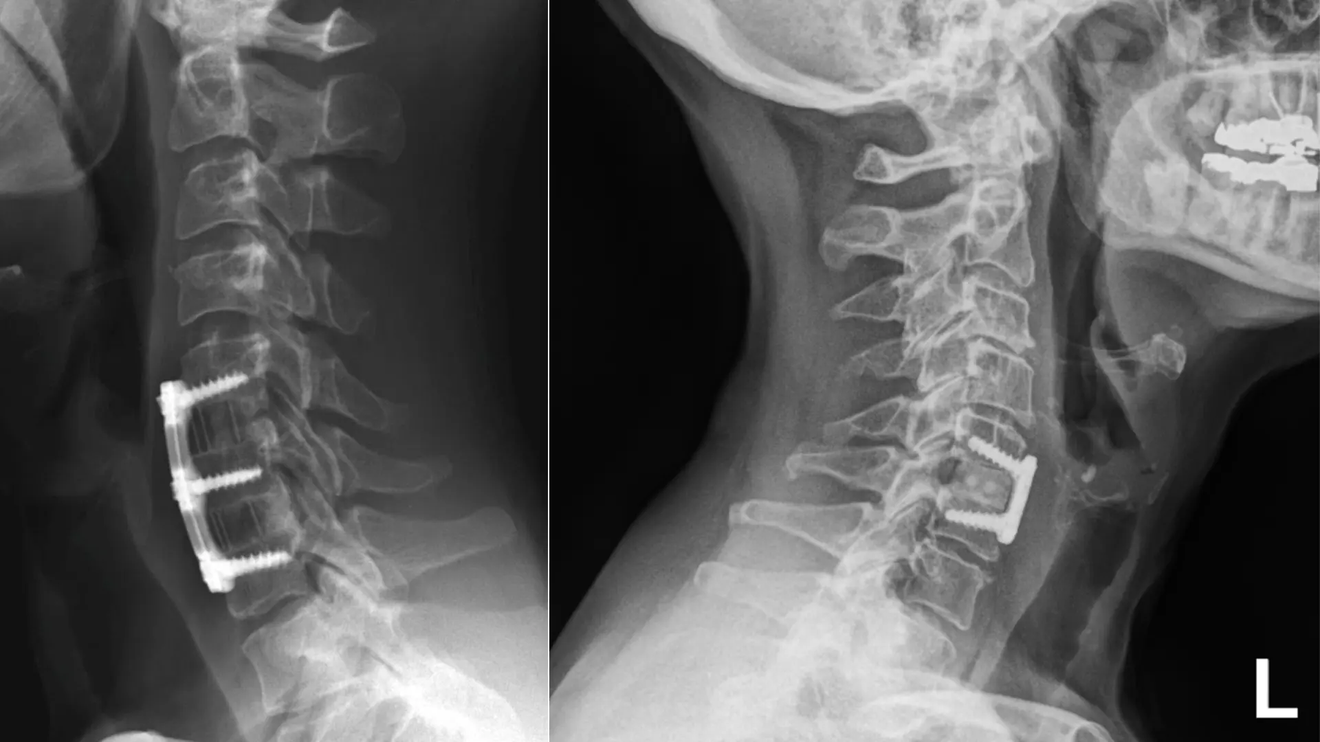 Cervical Discectomy Cervical Discectomy