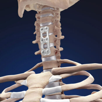 After Chiari Malformation Surgery: What to Expect