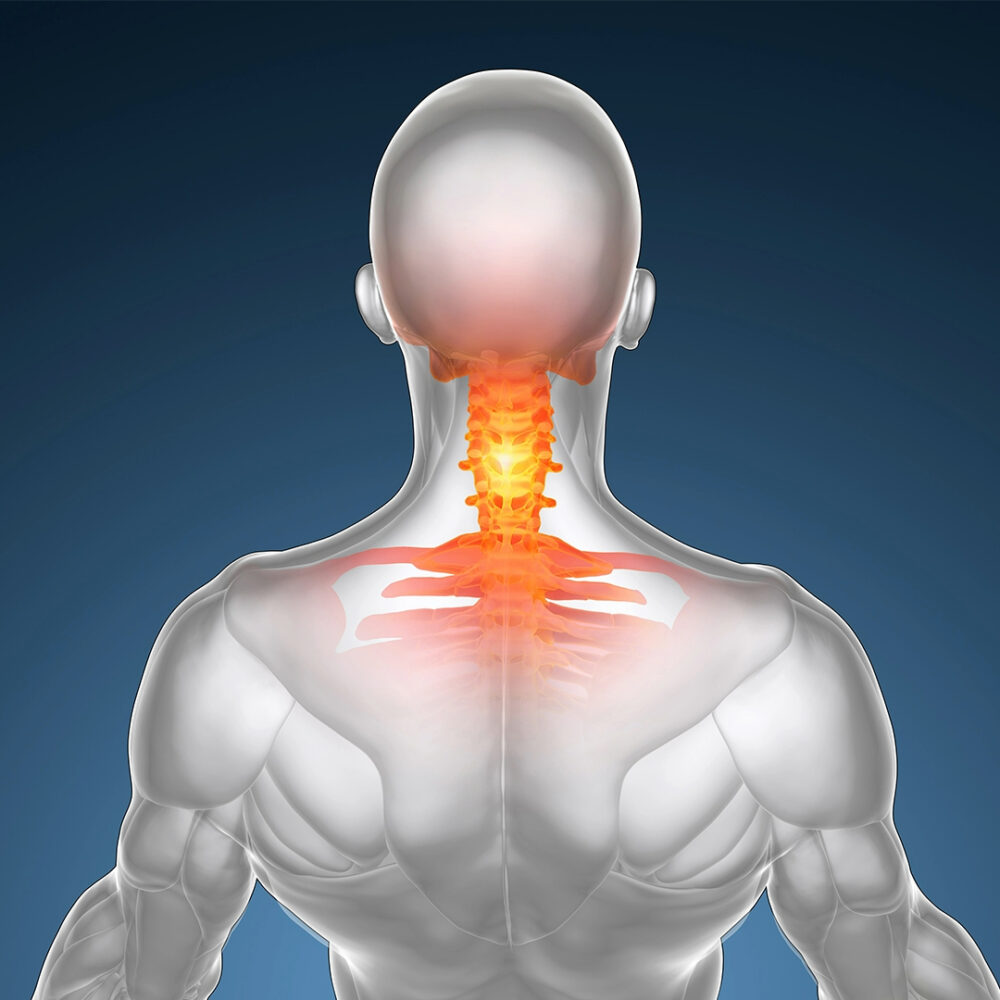 Caring for an ACDF Surgery Scar: Advice From a Spine Surgeon