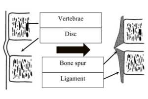 Cervical Myelopathy – Degenerative Spinal Cord Injury