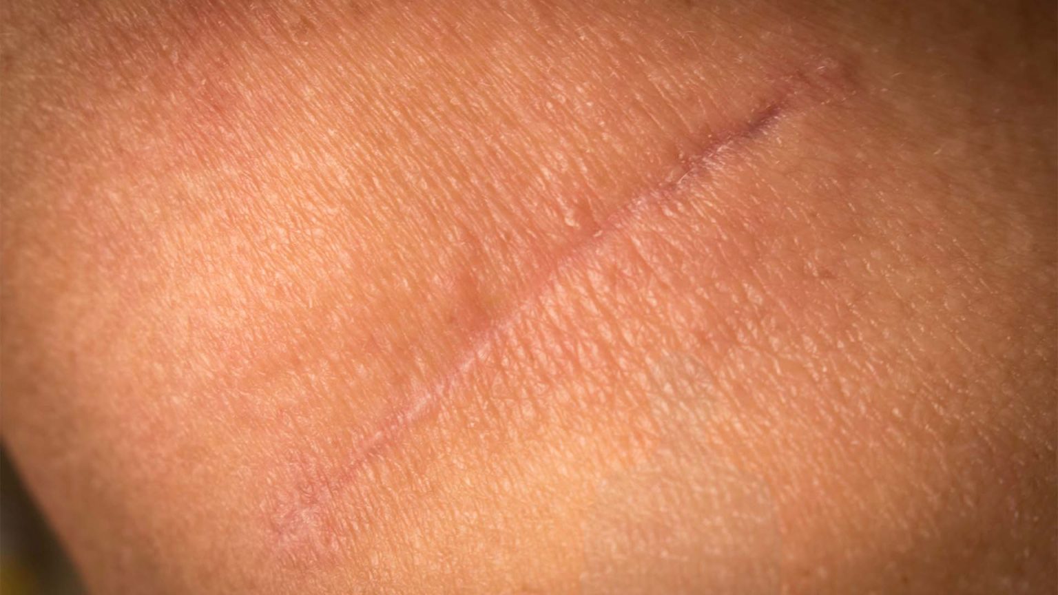 How Long Does It Take to Recover From Neck Surgery?