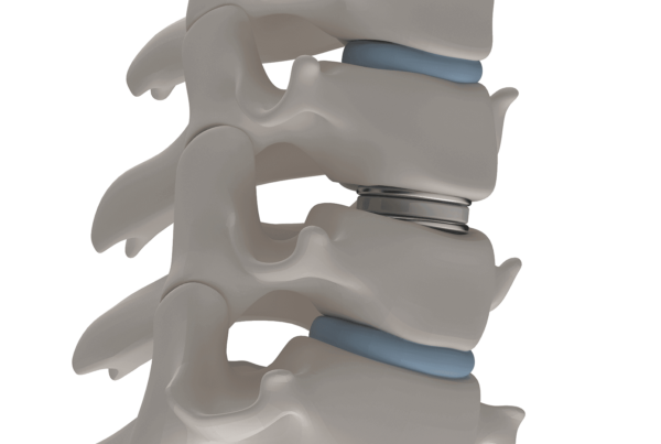 Cervical Foraminal Stenosis – Causes, Symptoms, and Treatment