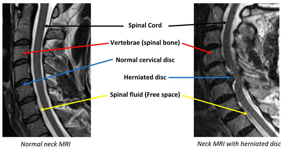 Neurosurgeonsofnewjersey Normal Neck Mri Vs With Herniated Disc Neurosurgeons Of New Jersey