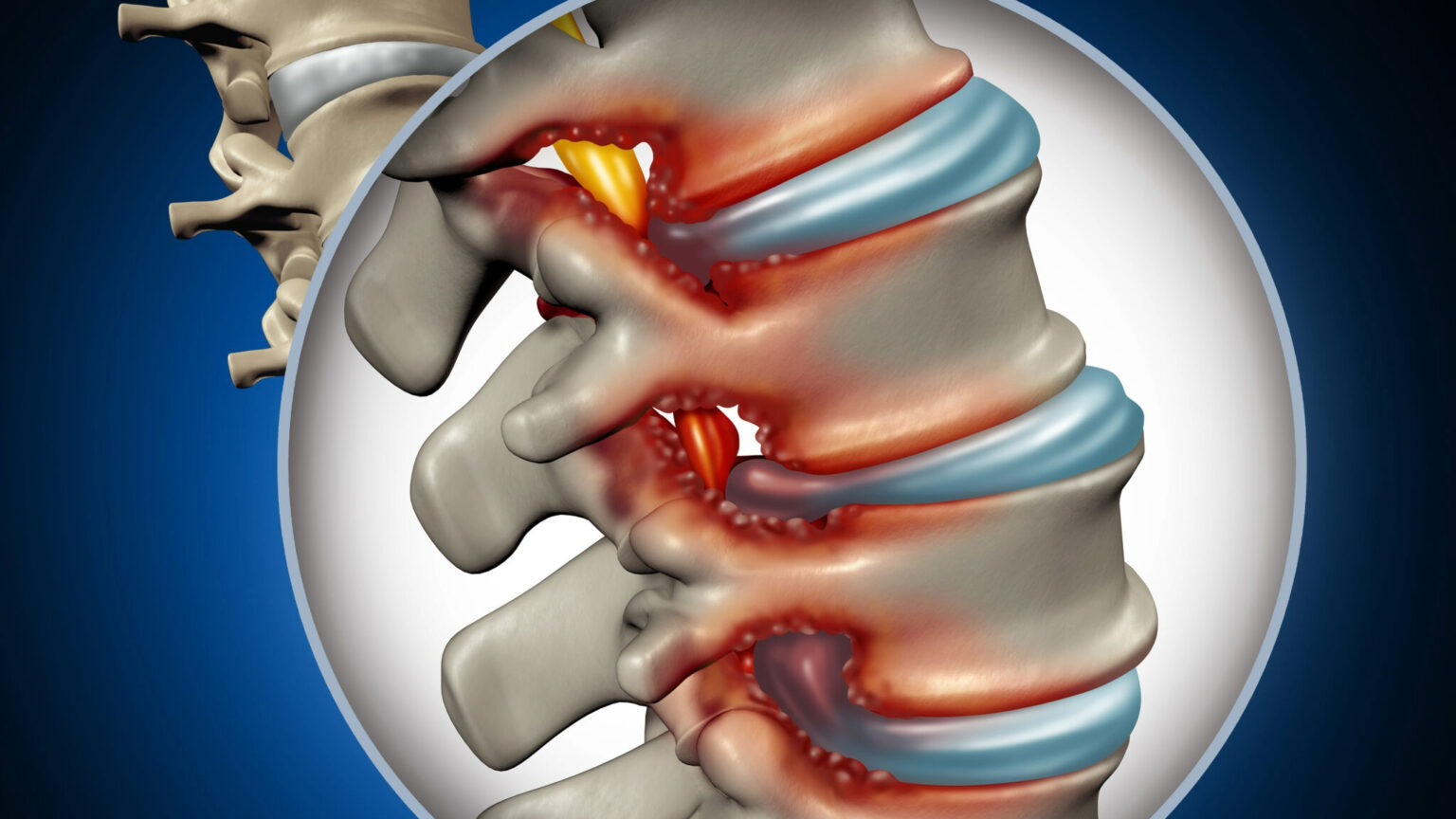 Cervical Spinal Stenosis Surgery Recovery What To Expect